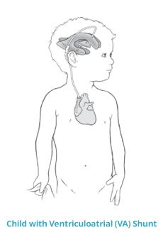What is a Shunt? Learn about Hydrocephalus shunts.