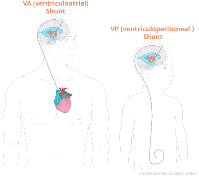 Understanding Shunt Systems | Hydrocephalus Association