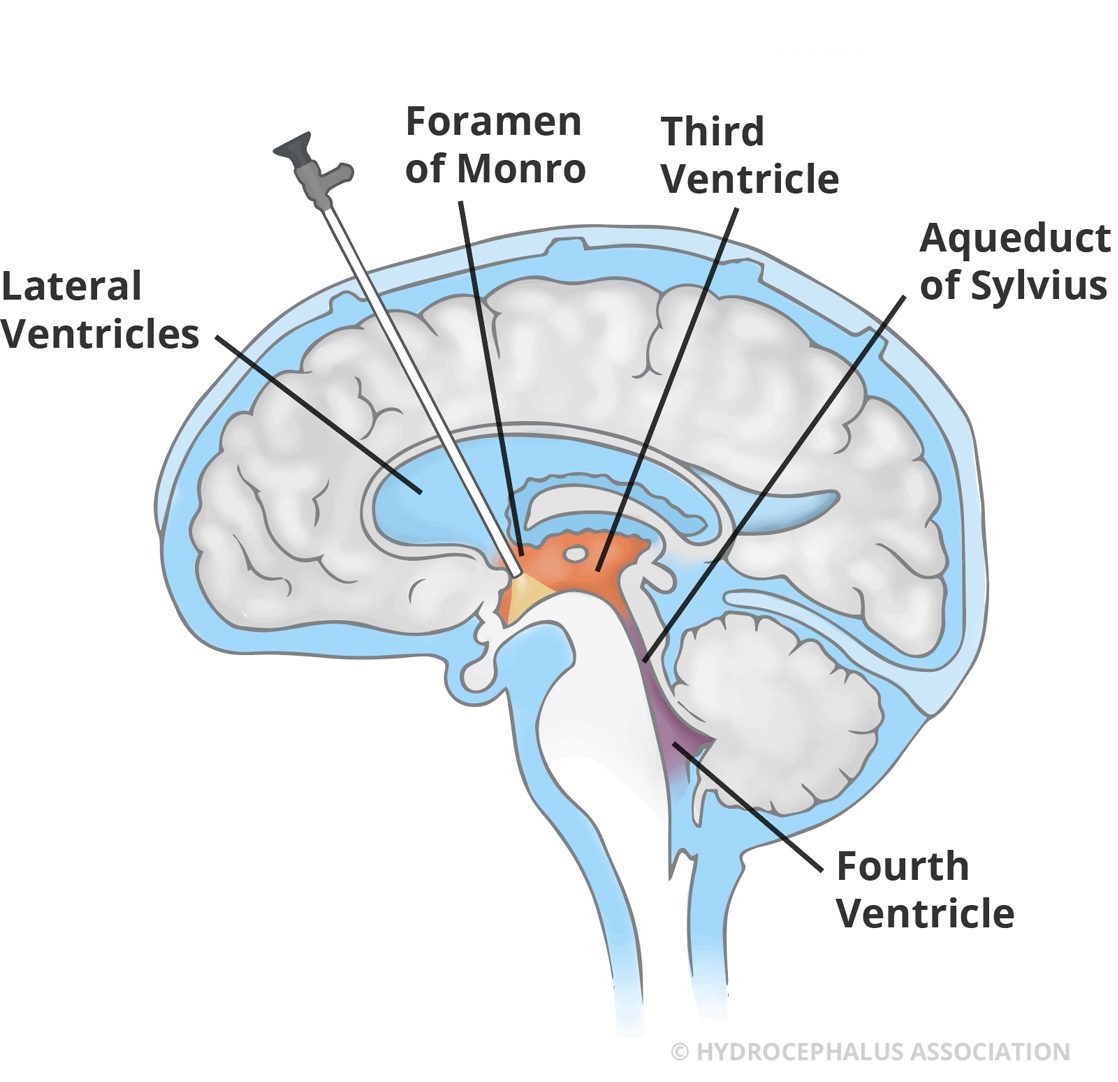 Hydrocephalus in Adults | Learn About the 4 Categories