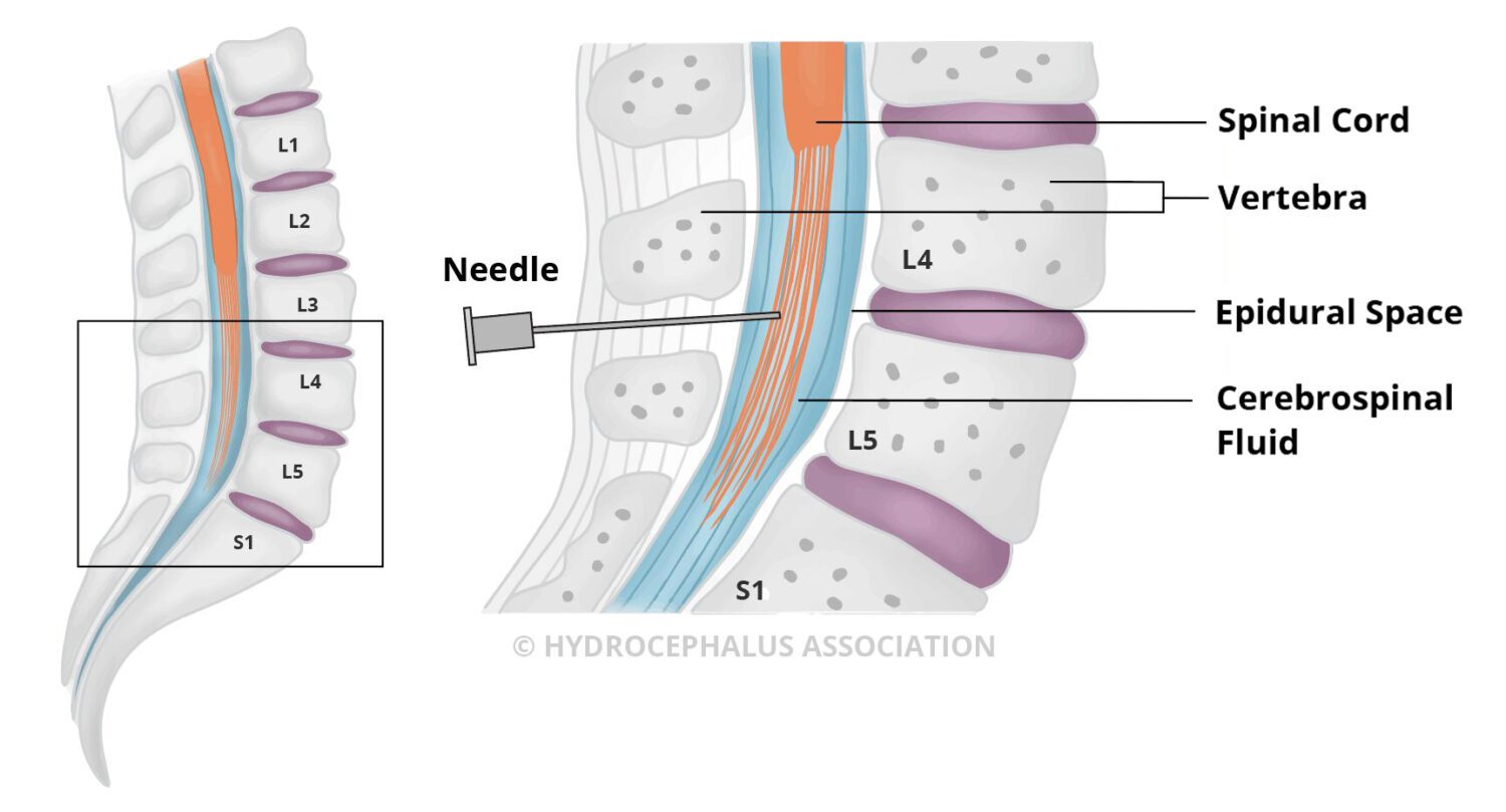 Hydrocephalus in Adults | Learn About the 4 Categories