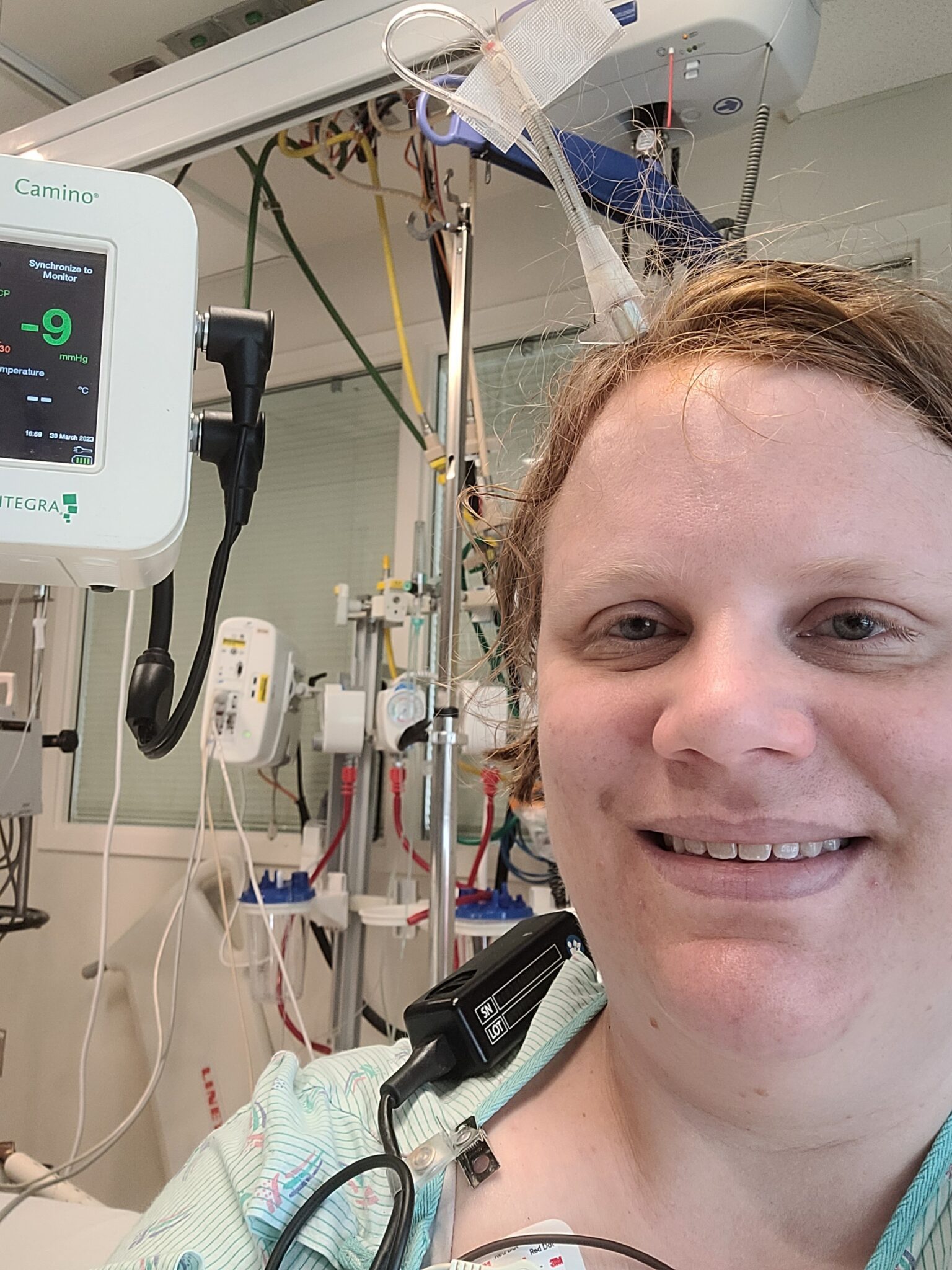 ICP Monitors in Hydrocephalus: When and Why They’re Used